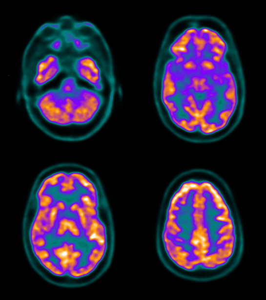Understanding Alzheimer’s Disease and How Amyloid PET/CT Imaging Can Help